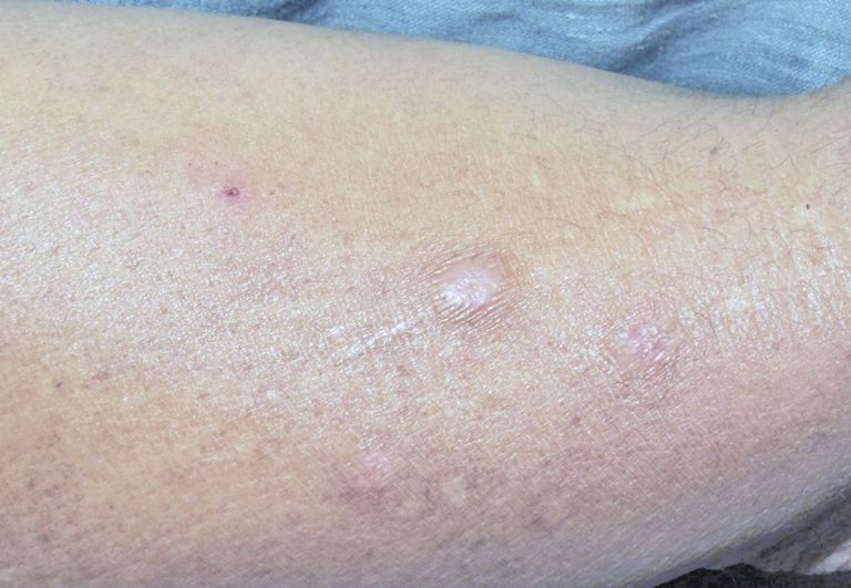 ¿Qué es el Prurigo actínico? | Diario Crónica